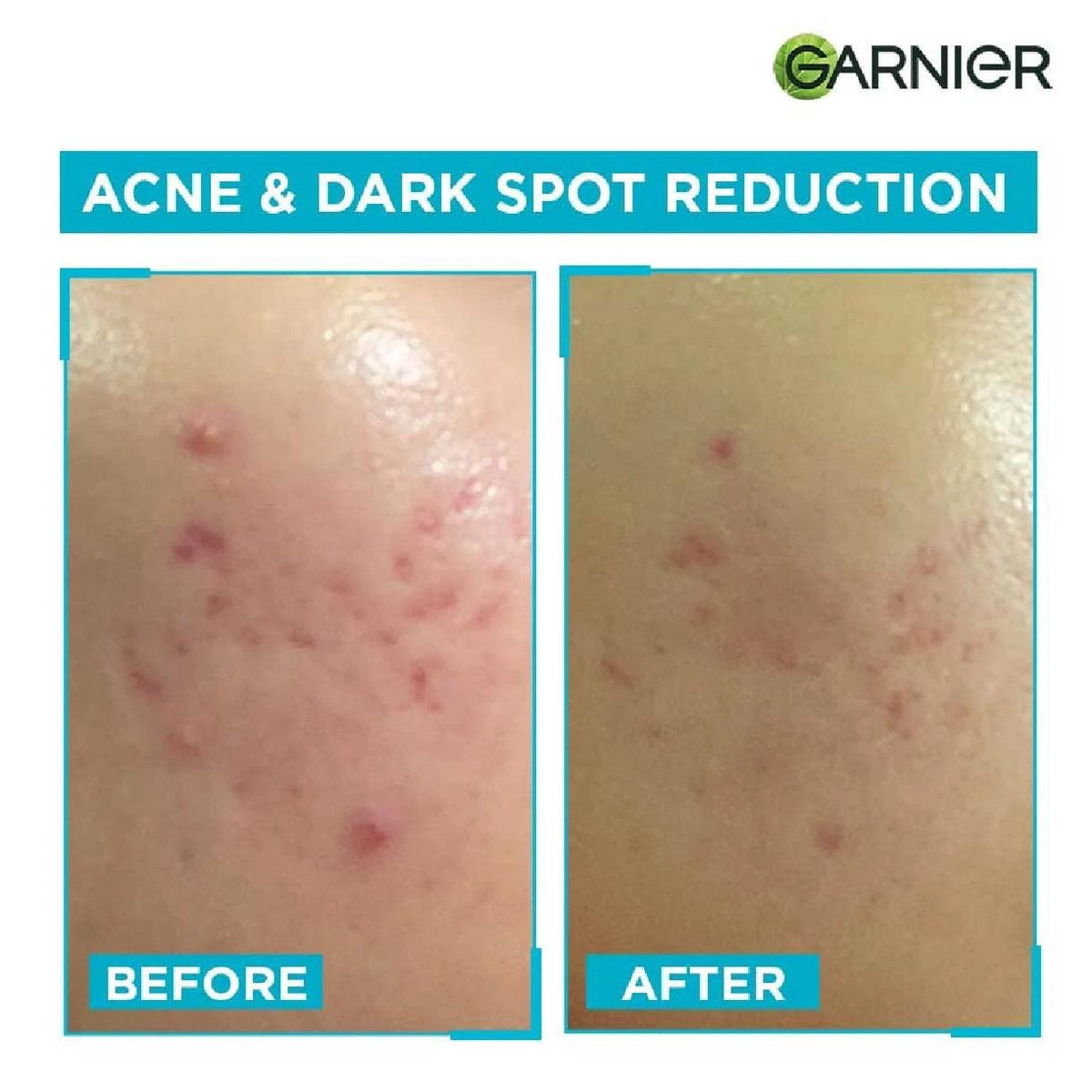 Garnier Anti-Acne Serum (30ml) – Glamour Glow